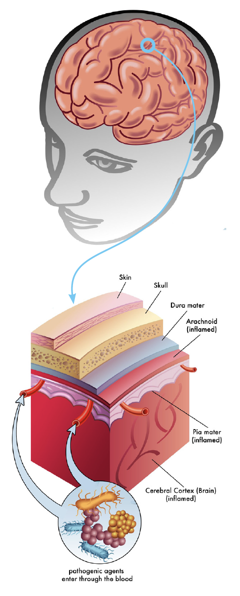 Viral and Bacterial Meningitis Facts | WorkCare